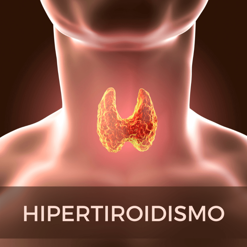 Sobre el hipertiroidismo – "SENTIRSE MAL NO ES NORMAL"